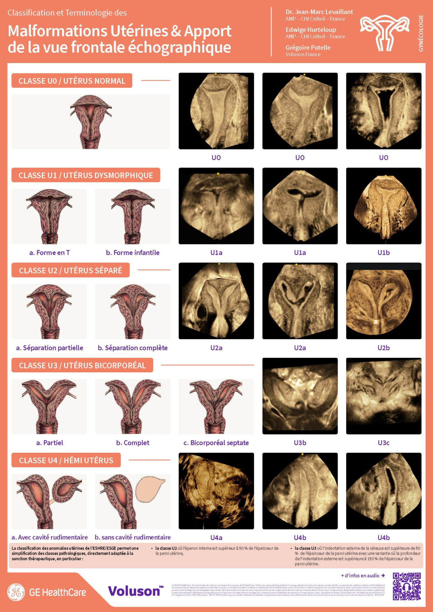 Nouvelle classification et terminologie des malformations utérines ...