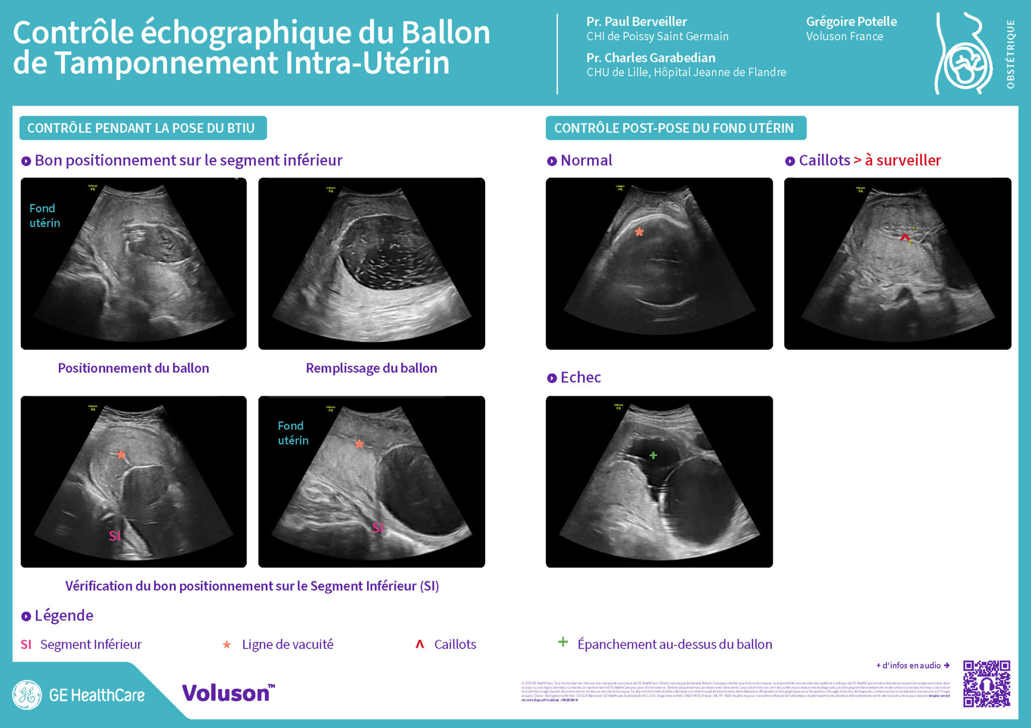 Contrôle échographique du Ballon de Tamponnement Intra-Utérin - Bloom ...