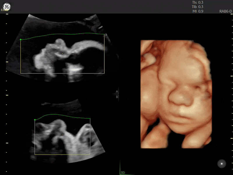 Bloom | Hoe de 3D-functie van Voluson™ indruk maakt op zowel team als ...